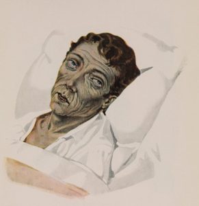 Cholera – Bath Medical Museum